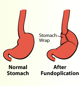 Fundoplication (Pediatric) | UCSF Department of Surgery
